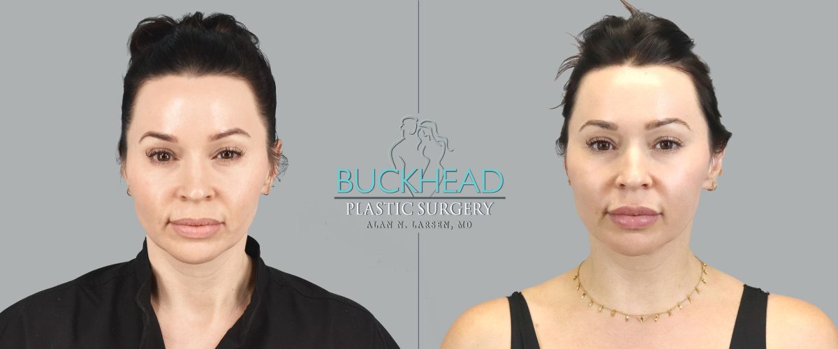 Before & After Gallery | FaceTite | Buckhead Plastic Surgery, Atlanta, GA