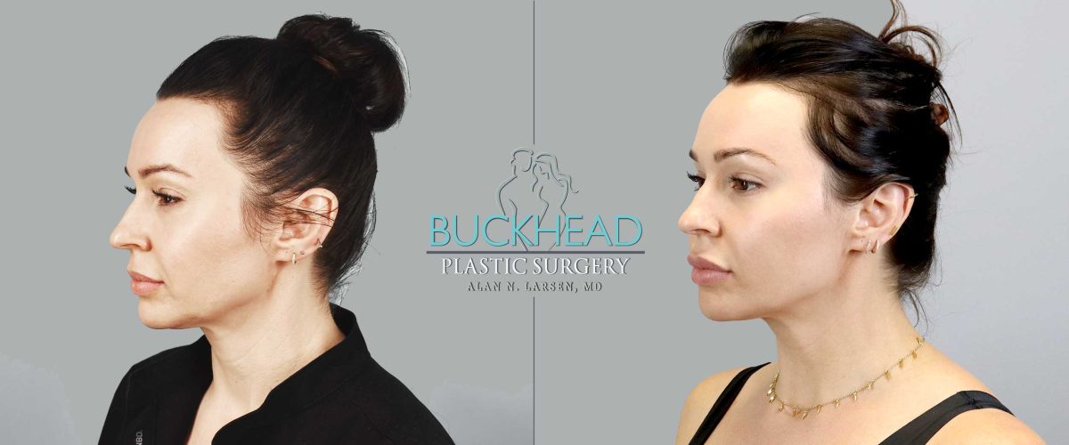 Before & After Gallery | FaceTite | Buckhead Plastic Surgery, Atlanta, GA