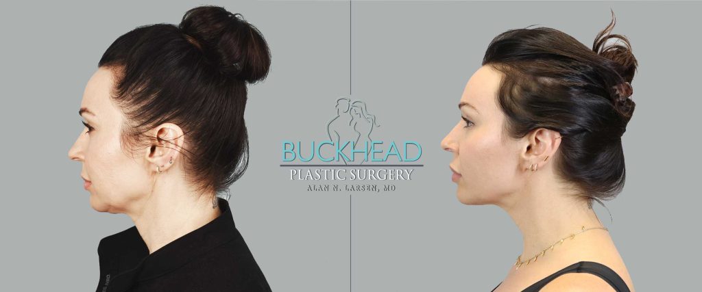 Before & After Gallery | FaceTite | Buckhead Plastic Surgery, Atlanta, GA